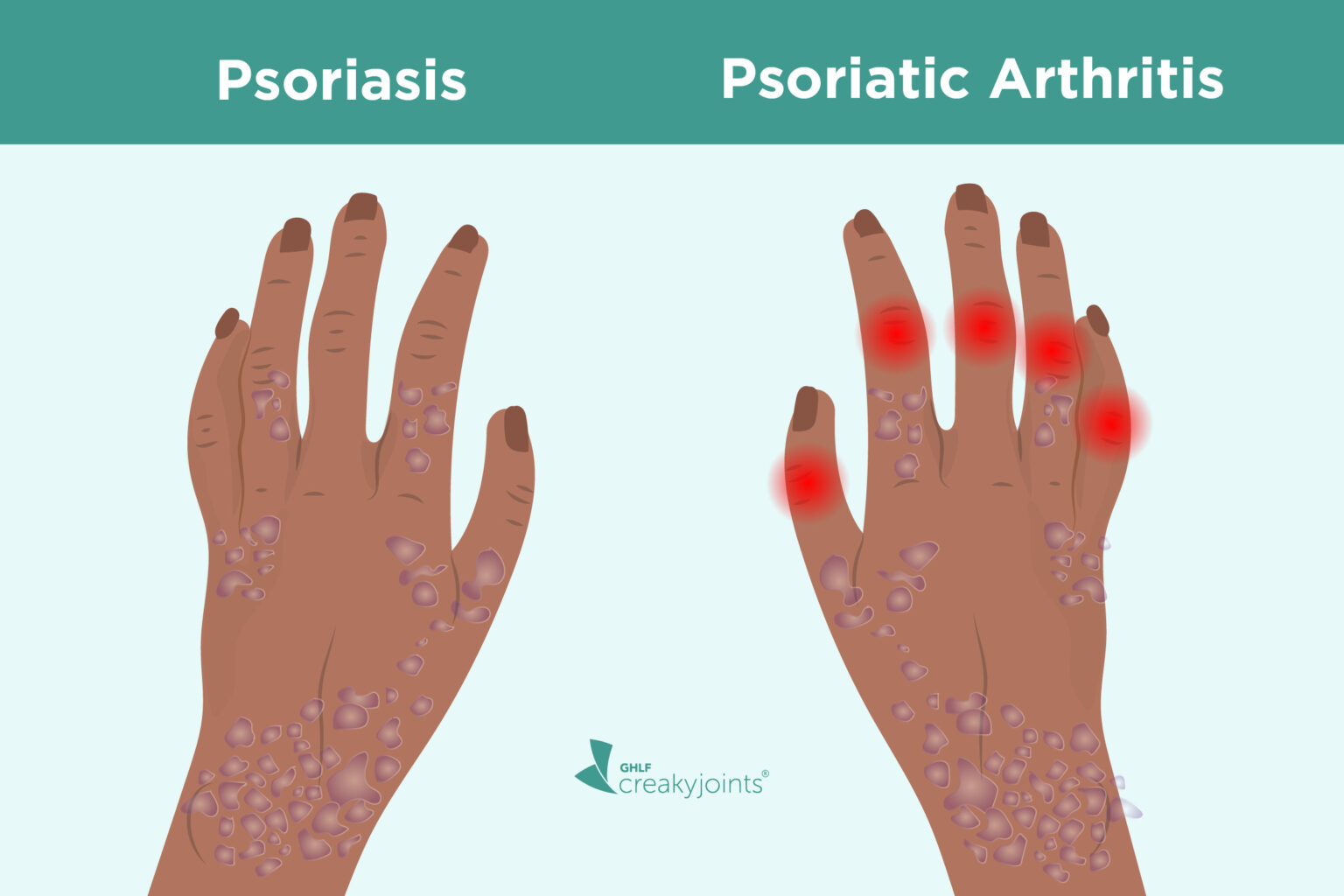BIPOC Patient Voices: Living with Psoriasis and Psoriatic Arthritis ...